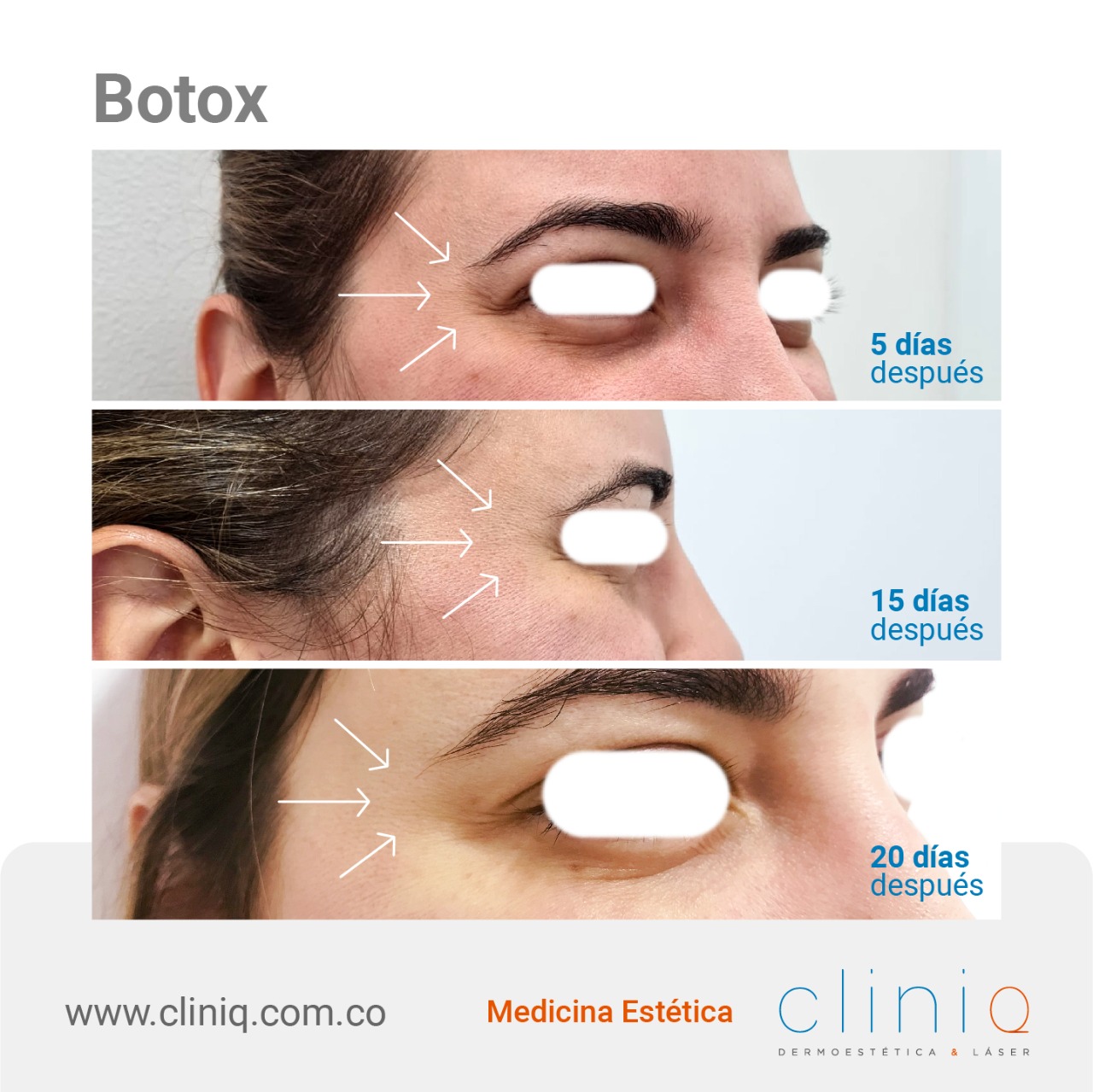 ¿Qué es el Botox y Cómo Reduce las Arrugas? - Cliniq