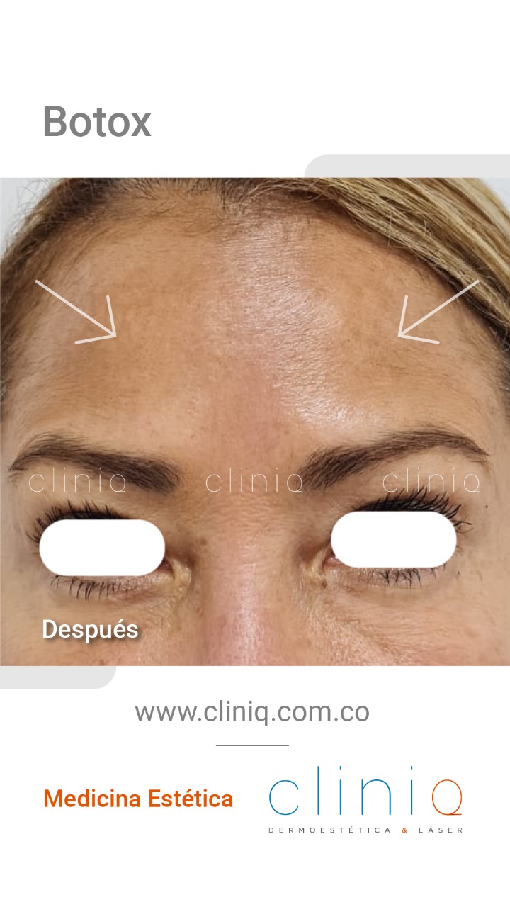 ¿Qué es el Botox y Cómo Reduce las Arrugas? - Cliniq