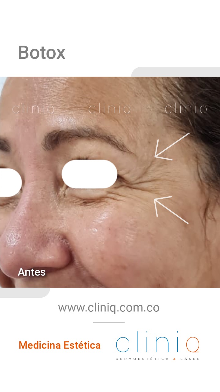 ¿Qué es el Botox y Cómo Reduce las Arrugas? - Cliniq
