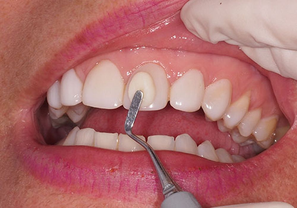 Resinas anteriores y posteriore - Odontología Estética Cliniq